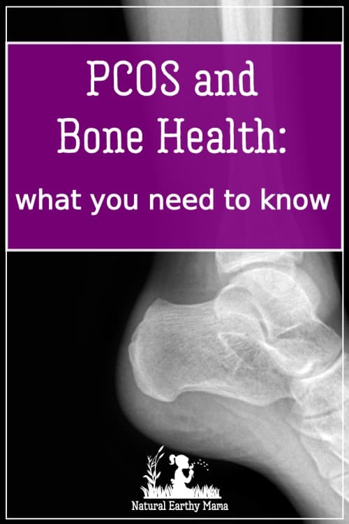 Everything You Need to Know About PCOS and How it Affects Bone Health
